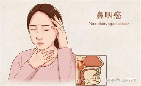 【医疗资讯】女子鼻塞2个月一查竟是鼻咽癌！这些早期信号要注意 知乎