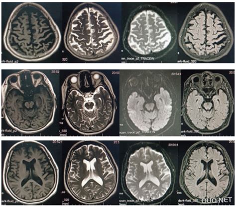皮质基底节变性（皮质基底节综合征） Ouq技术分享