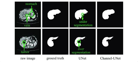 example of over segmentation and under segmentation in liver