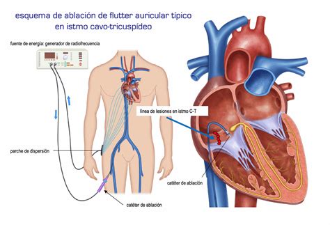 Causas Y Tratamiento Del Flutter Auricular Instituto De Arritmias
