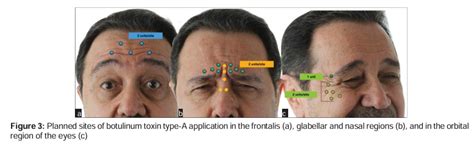 Botulinum Toxin For Eyebrow Repositioning And Facial Rejuvenation Case Report