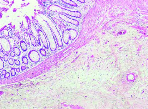 Complete Pathologic Response After Neoadjuvant Chemoradiotherapy Hande Download Scientific