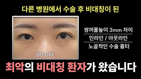 [실제성형리뷰] 쌍꺼풀 수술 후 비대칭이 된 환자를 쌍꺼풀 재수술로 치료한 과정 Youtube