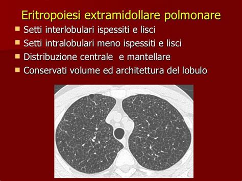 Ipertensione Polmonare Imaging Radiologico