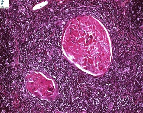 Multilocular Thymic Cyst Human Pathology Photos Pictures Videos