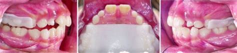 Digital Expansion With The Invisalign Palatal Expander