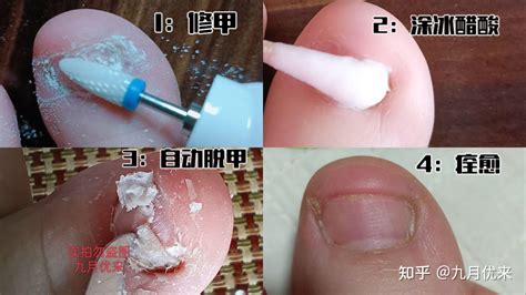灰指甲的2种脱甲方法，在家自己就能轻松搞定，3个月摆脱灰指甲，6年实战经验分享 知乎