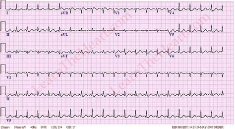 Atrial Flutter With Variable Block