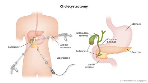 Cholecystectomy Gallbladder Removal