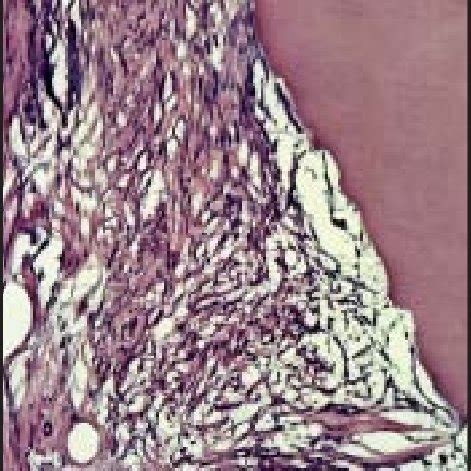 Root Coverage Outcomes Complete Root Coverage And Mean Root Coverage Download Table