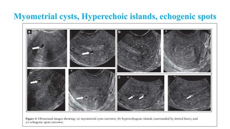 Adenomyosis Or Fibroid Making Right Diagnosis Pptx