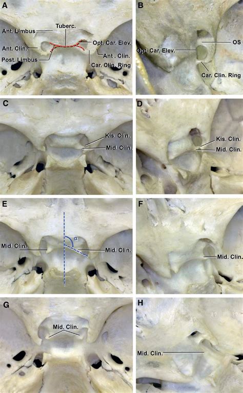 Middle Clinoid Process