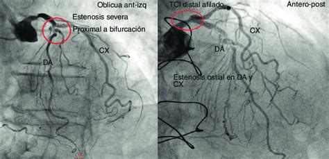 Coronariografía Diagnóstica Estenosis Distal Severa Del Tronco De La
