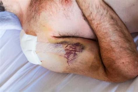 Subacromial Decompression Surgery Advice And Exercises