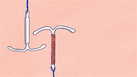 The Coil What Is The Difference Between An IUD And An IUS Spunout
