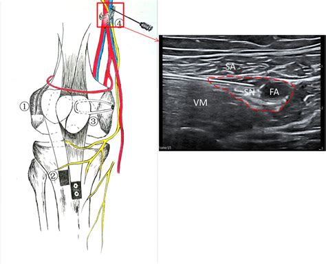 “3‐in‐1” Procedure Surgery With Recurrent Patellar Dislocation And Download Scientific Diagram