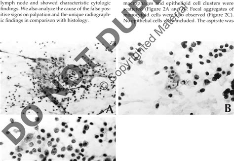 Cytologic Findings In Tl A Epithelioid Cell Cluster On A Background Download Scientific
