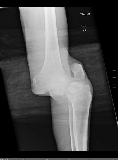 Knee Dislocation Meded Cases