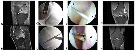 Ijms Free Full Text Spontaneous Bone Marrow Edema Perfusion Abnormalities And Treatment