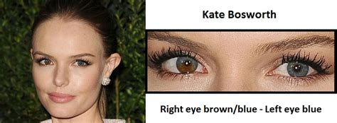 The American Actress Kate Bosworth Is Another Celebrity With Partial
