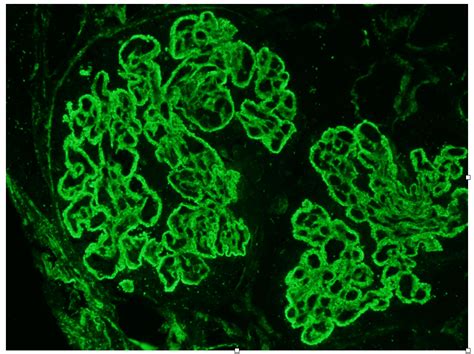Membranous Glomerulopathy Subtyping Teaching Point