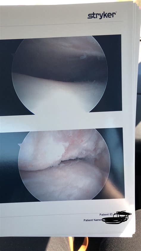 Scar Tissue Build Up Before And After Debridement Rmildlyinteresting