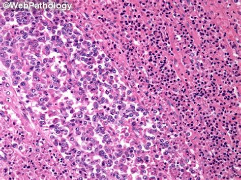 Steroid Cell Tumor Nos Necrosis