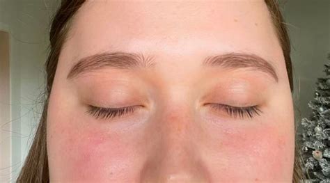 Eczema Face Causes Eczema Of The Face And Neck Eau Thermale Avène