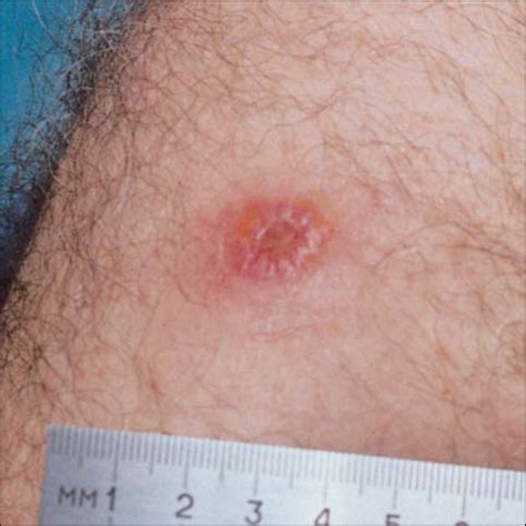 Scab Fell Off And Left A Hole A Pictures Of Hole