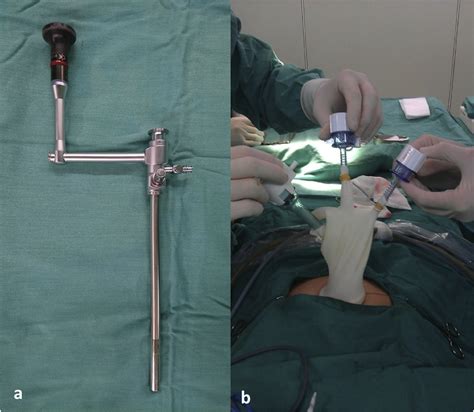 Should Single Incision Laparoscopic Appendectomy Be The New Standard