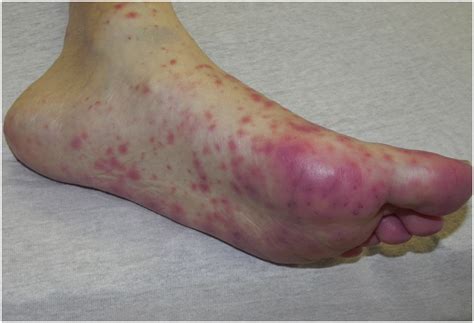 Neutrophilic Dermatoses