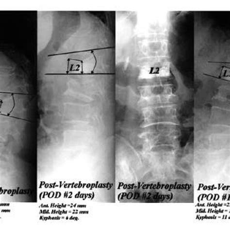 Radiograph Of 73 Year Old Female Shows L2 Compression Fracture The