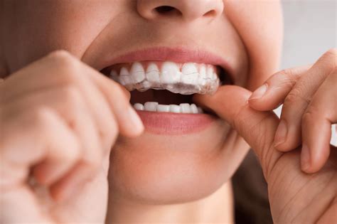 Avoid The Risks The Hidden Dangers Of DIY Braces Thedentalgroup Com