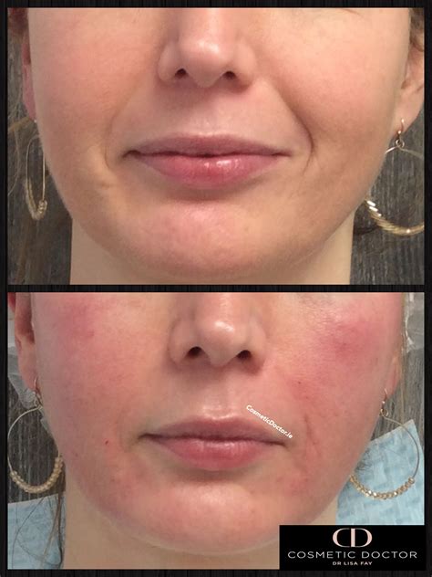 Nasolabial Fold Before And After