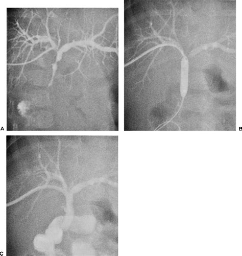 Percutaneous Transhepatic Biliary Dilitation And Drain Placement A A