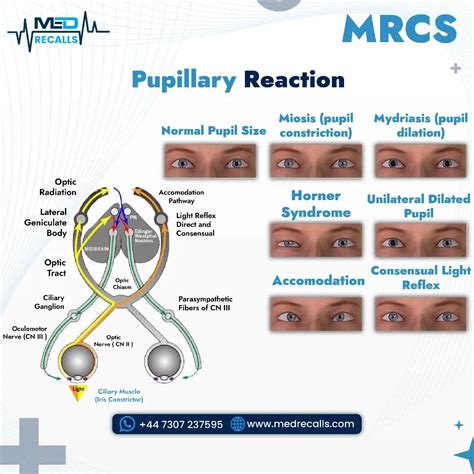 Med Recalls What Is Pupillary Reaction