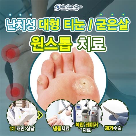오클릭 클리닉 난치성대형티눈 방치말고 오클릭의원 원스톱치료 진행🏥👩🏻‍⚕️ 11 개인상담