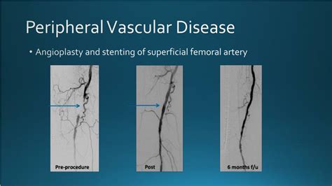 Ppt What Is Interventional Radiology Powerpoint Presentation Free