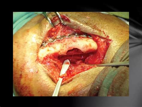 Chronic Osteomyelitis Of The Mandible Case Report Pptx