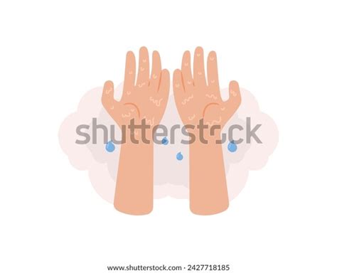 Symptoms Hyperhidrosis Illustration Very Sweaty Palms Stock Vector