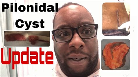 When Can I Shower After Pilonidal Cyst Surgery At Frederick Saechao Blog