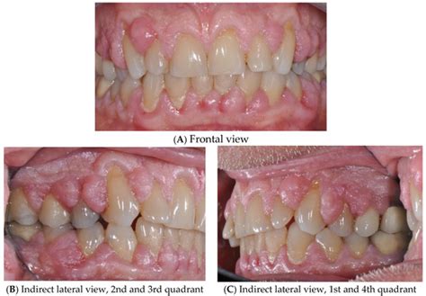 Calcium Antagonist Induced Gingival Overgrowth A Case Report And