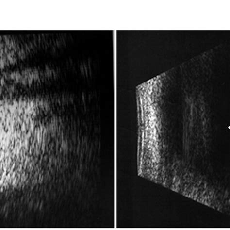 B Scan Ultrasonography Of Both Eyes During The Patients First Visit Download Scientific