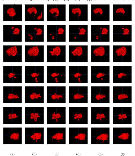 Figure From Semi Supervised D Medical Image Segmentation Using Transformer And CNN Semantic