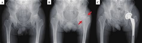 Pelvic X Ray Transition A Pelvic X Ray At The Admission To Out Download Scientific Diagram