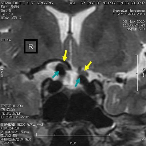 Dr Balaji Anvekar Frcr Optic Nerve Compression By Normal Ica