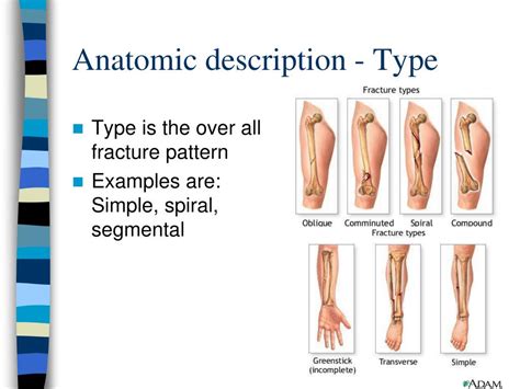 PPT Fracture Classification PowerPoint Presentation Free Download ID 6072872