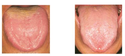 Tongue Moisture Flashcards Quizlet