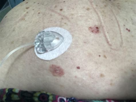 Advanced Insulin Pumps And Cgm Compatibility Guide 2025 Update