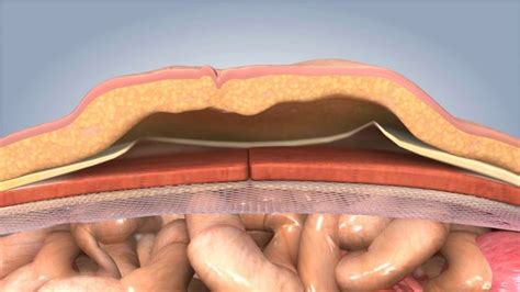Umbilical Hernia Repair By Dr David W Ford